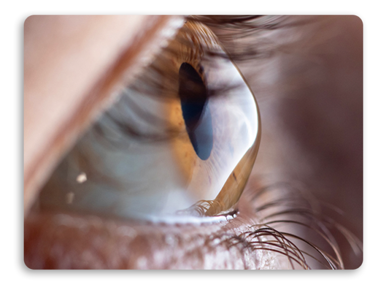 Eye Conditions - Clervision