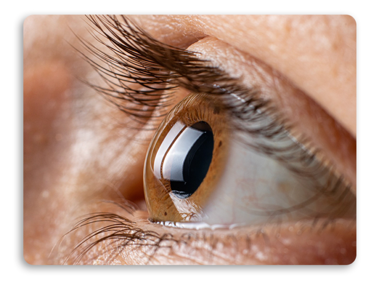 Eye Conditions - Clervision