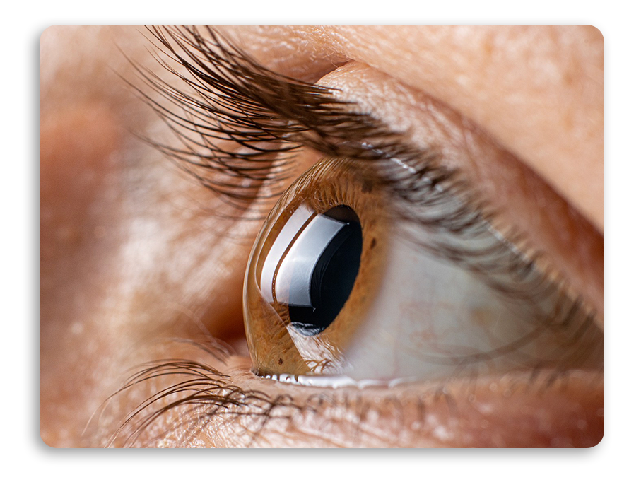 Eye Conditions - Clervision