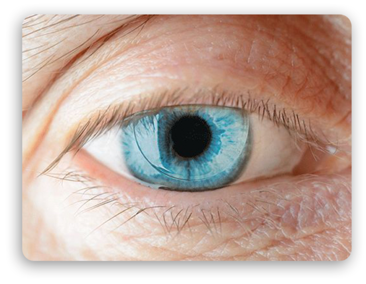 Corneal - Clervision