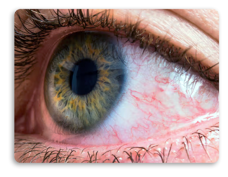 Eye Conditions - Clervision