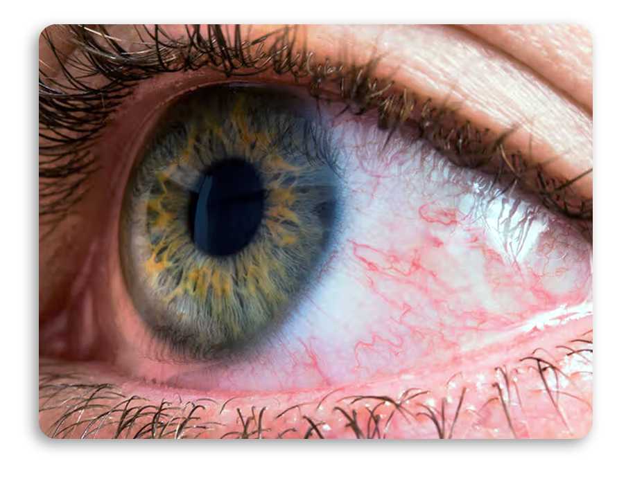 Eye Conditions - Clervision