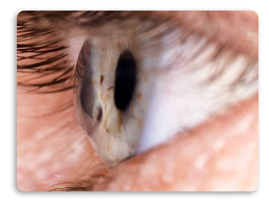 Eye Conditions - Clervision